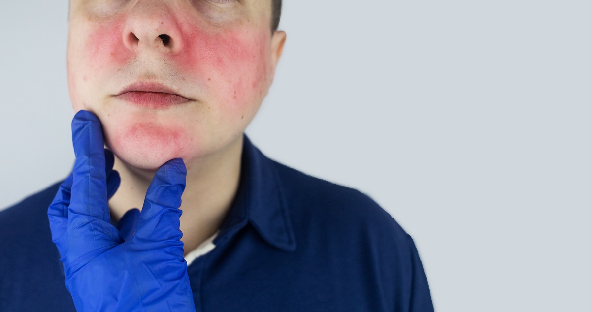 Dermatitis atópica: síntomas y tratamientos para humanos | AllYouCanTrend