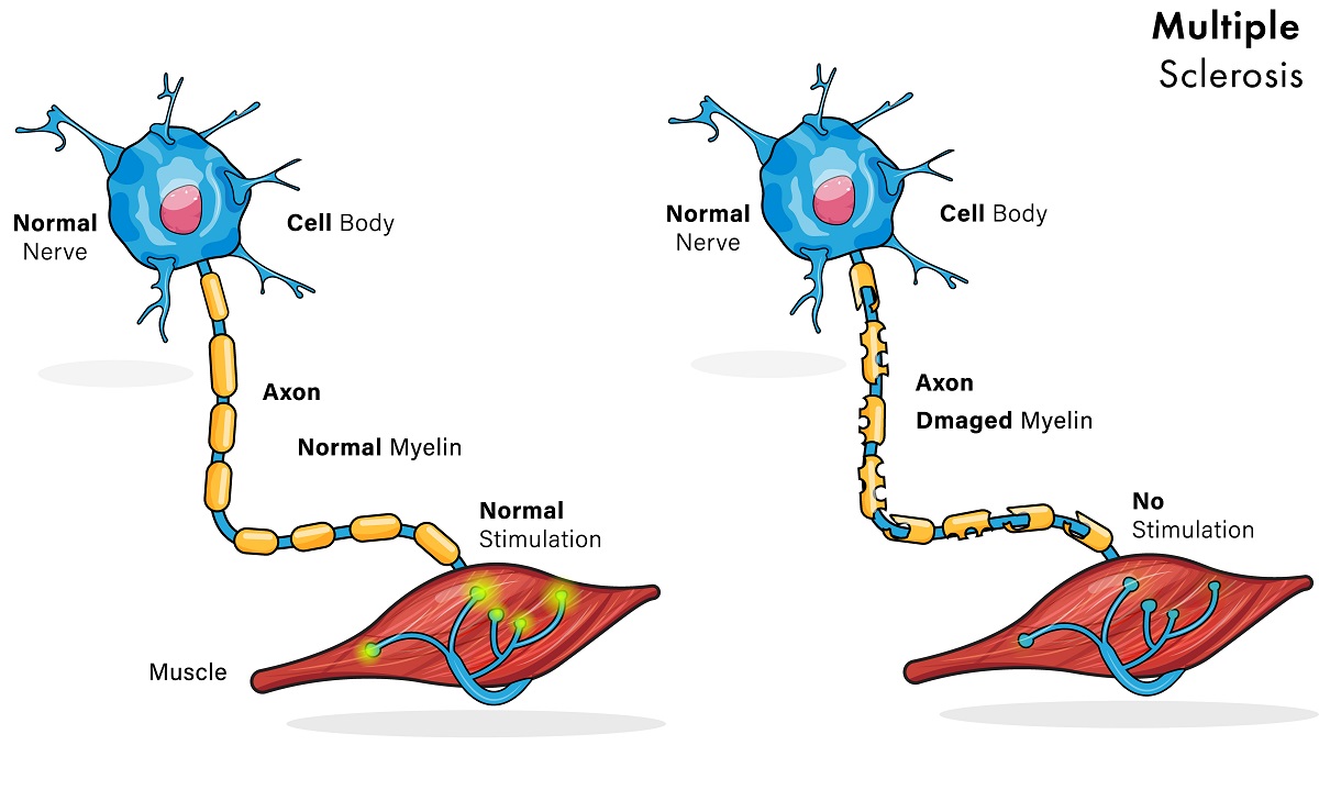 Multiple sclerosis: symptoms and difficulties for humans | AllYouCanTrend